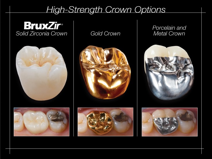 What is a crown? - Dental Braces Information